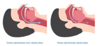 SAOS : symptômes, causes et traitements | Blog CPAP STORE